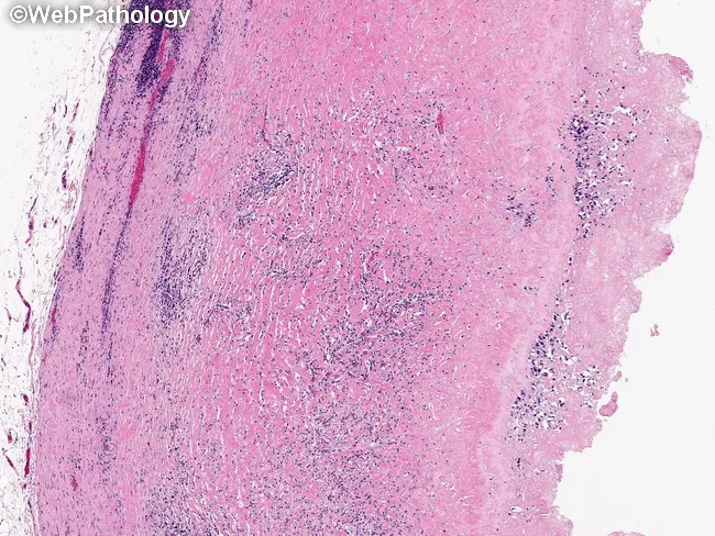 Breast Implant-associated ALCL