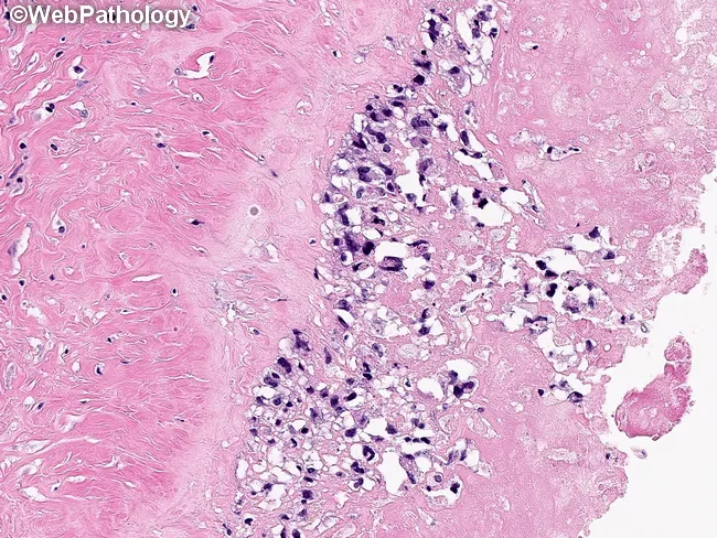 Breast Implant-associated ALCL