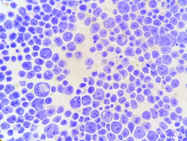 Breast Implant-associated ALCL