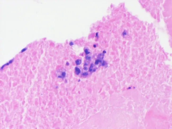 Breast Implant-associated ALCL