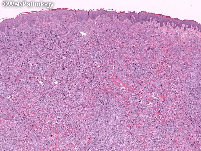 Primary Cutaneous ALCL