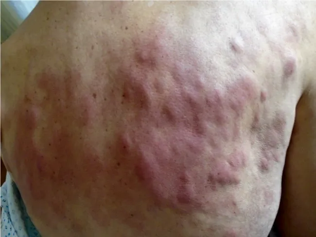 AITL : Clinical Features