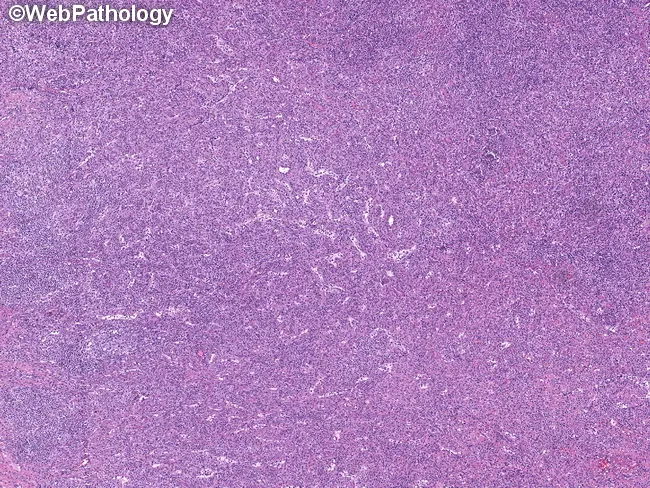 AITL : Morphology - High Endothelial Venules