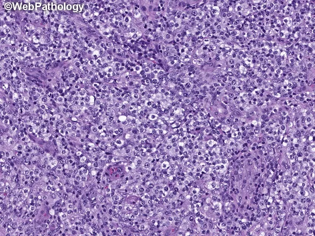 AITL : Cellular Infiltrate