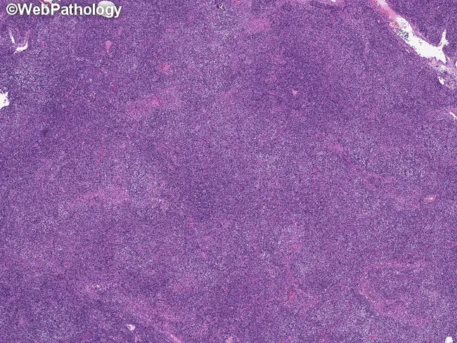 Follicular Peripheral T-cell Lymphoma