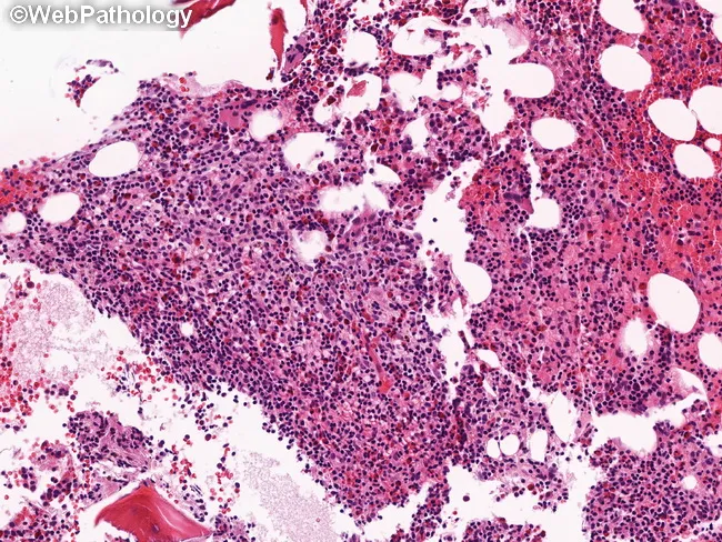 AITL involving Bone Marrow