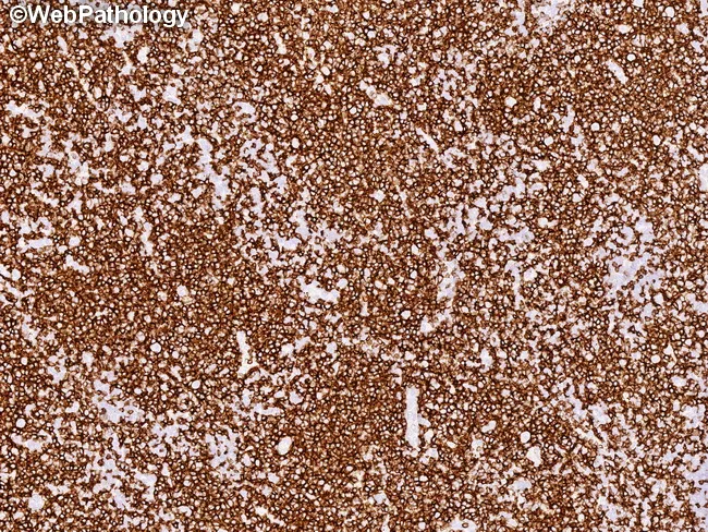 AITL : Immunophenotype - CD5