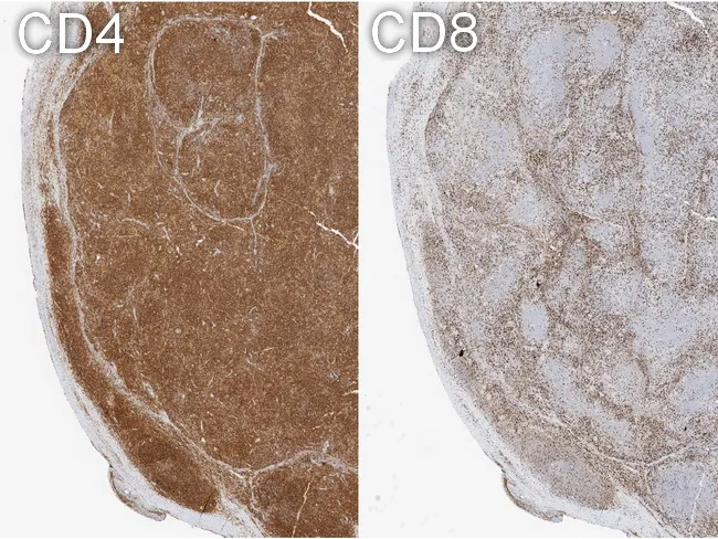 AITL : Immunophenotype - CD4 vs CD8
