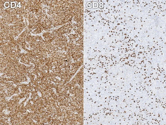 AITL : Immunophenotype - CD4 vs CD8