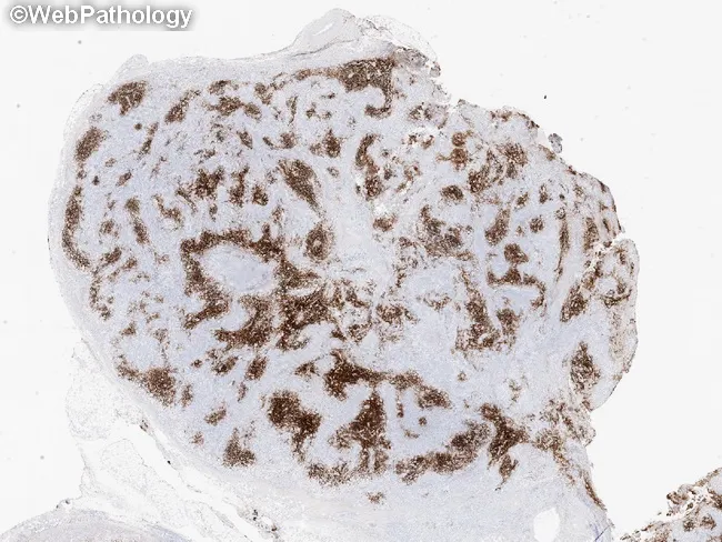 Follicular Dendritic Cell Networks in AITL : CD21