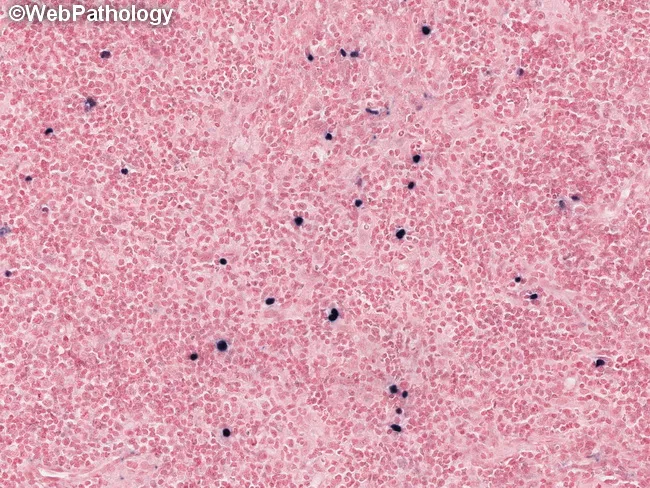 AITL : Relationship with EBV