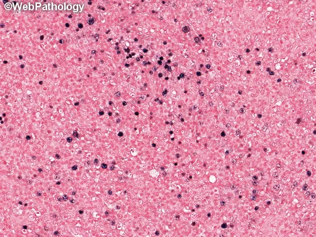 AITL : Relationship with EBV