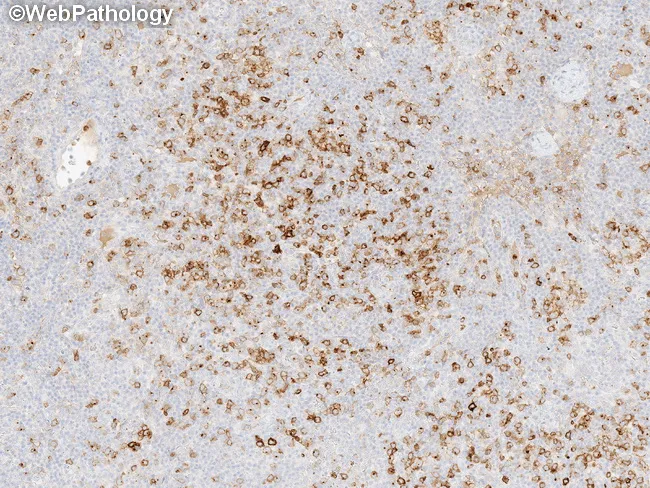 AITL : Immunophenotype - CD10