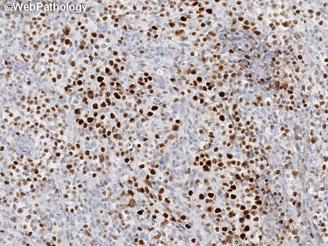 AITL : Immunophenotype - BCL6