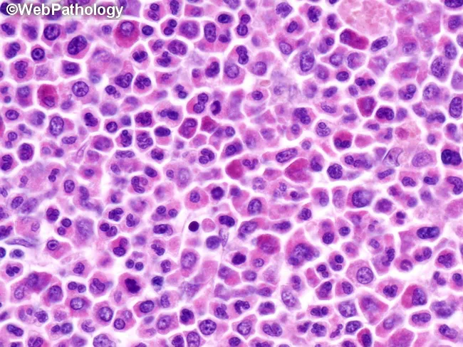 Myeloid Sarcoma : Introduction