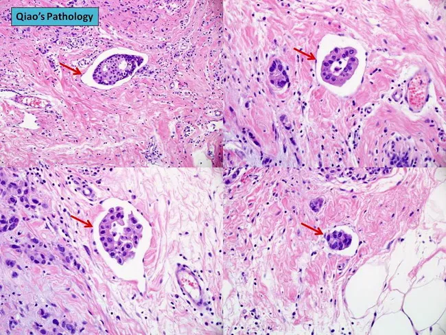 Lymphovascular Invasion in Ductal CA