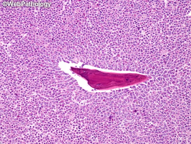 Myeloid Sarcoma : Microscopic