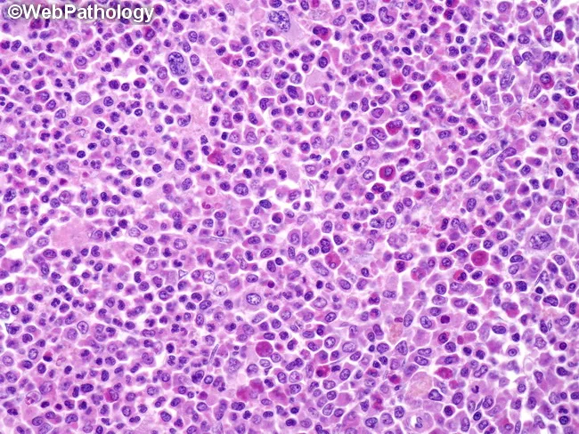 Myeloid Sarcoma : Microscopic