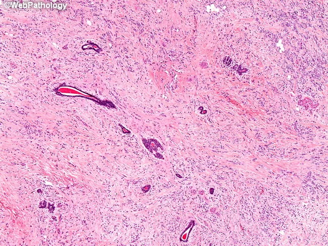 Infiltrating Lobular Carcinoma