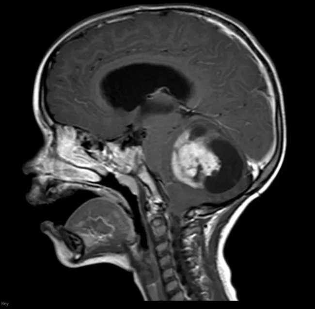 Pilocytic Astrocytoma