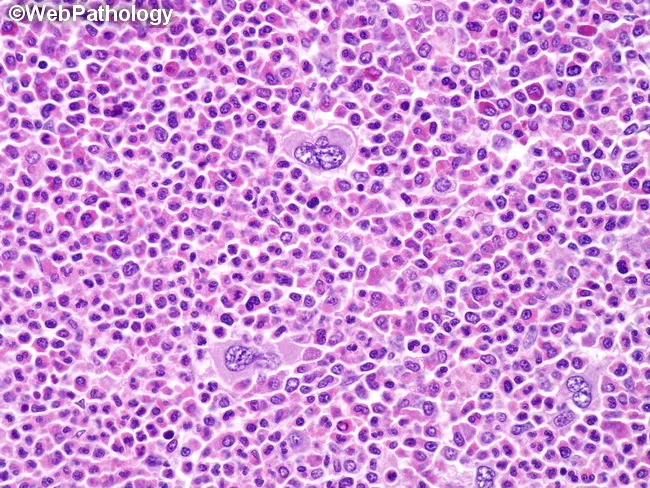 Myeloid Sarcoma : Microscopic
