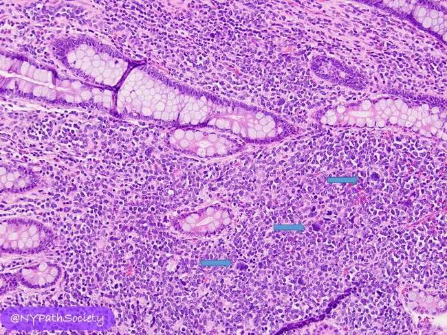 Myeloid Sarcoma : Cytogenetics
