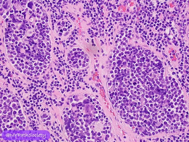 Myeloid Sarcoma : Differential