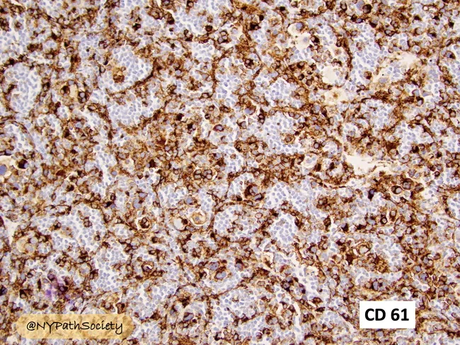 Myeloid Sarcoma : CD61