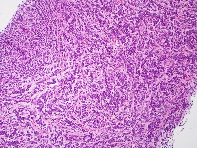 Myeloid Sarcoma