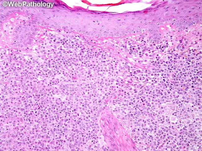 Myeloid Sarcoma : Skin