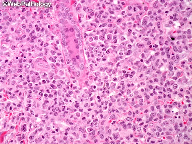 Myeloid Sarcoma : Skin