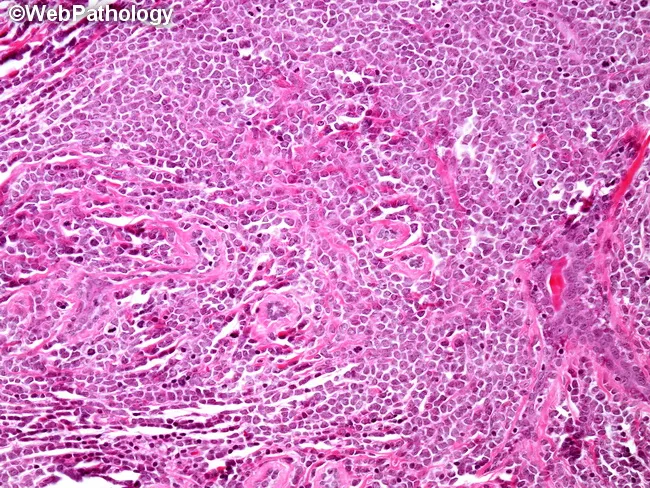 Myeloid Sarcoma : Breast