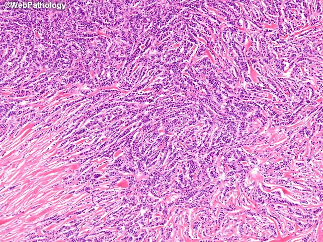 Infiltrating Lobular Carcinoma
