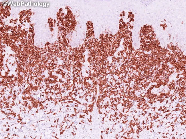 Mastocytosis : CD117