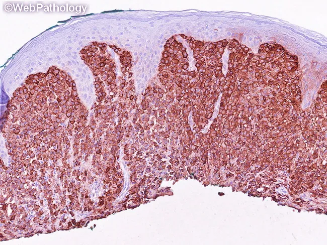 Mastocytosis : Tryptase