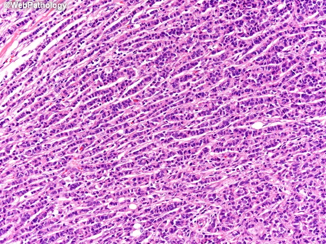 Infiltrating Lobular Carcinoma