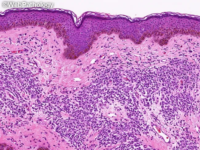 Urticaria Pigmentosa Histology Pathology Outlines Cutaneous