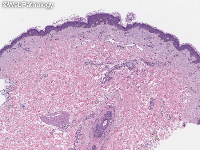 Telangiectasia Macularis Eruptiva Perstans