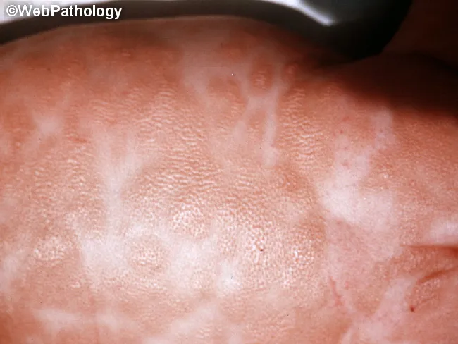 Diffuse Cutaneous Mastocytosis