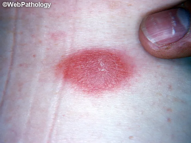 Cutaneous Mastocytoma : Intro & Clinical