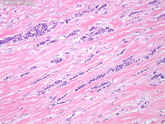 Infiltrating Lobular Carcinoma