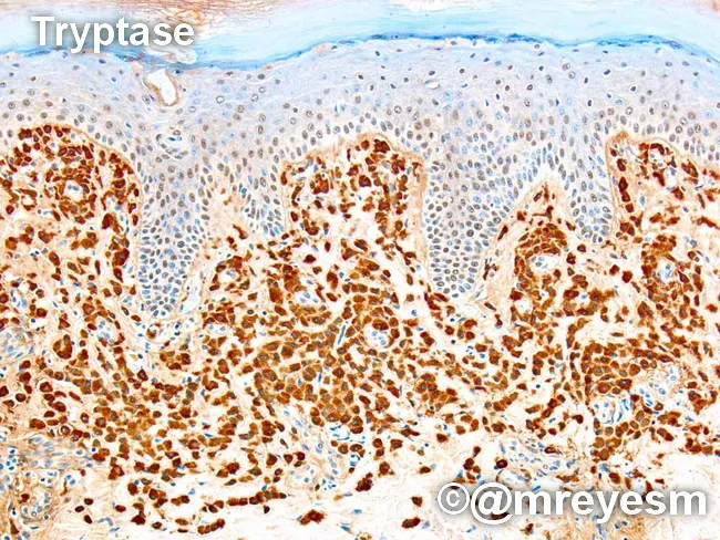 Cutaneous Mastocytoma : Tryptase