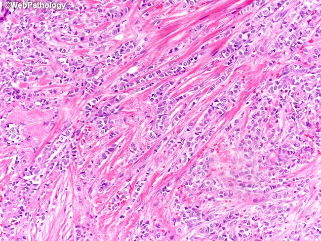 Infiltrating Lobular Carcinoma