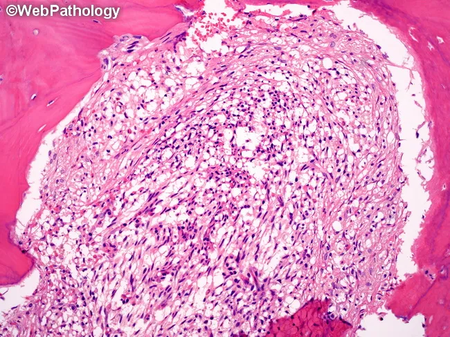 Systemic Mastocytosis : Bone Marrow