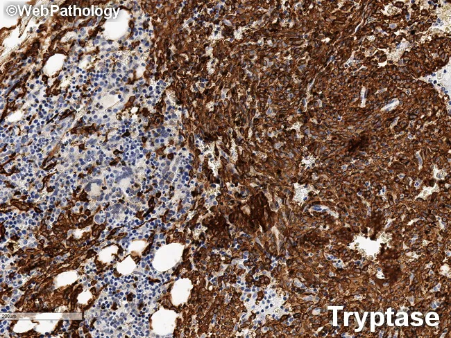 Systemic Mastocytosis : Bone Marrow - Tryptase