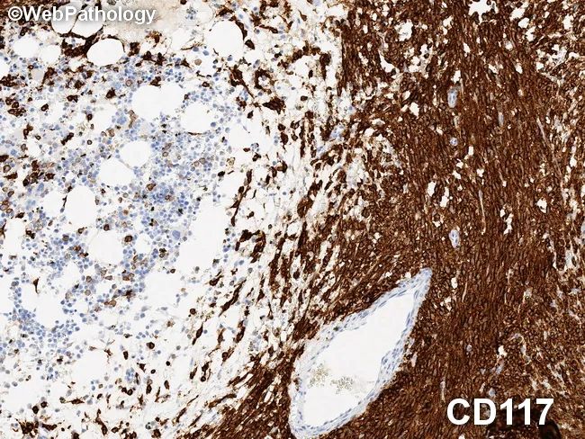 Systemic Mastocytosis : Bone Marrow - CD117