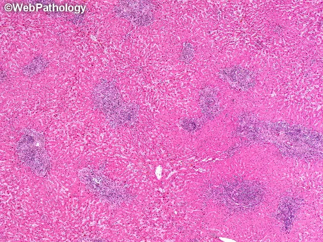 Systemic Mastocytosis : Liver