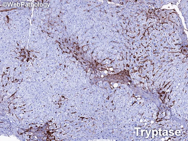 Systemic Mastocytosis : Liver - Tryptase
