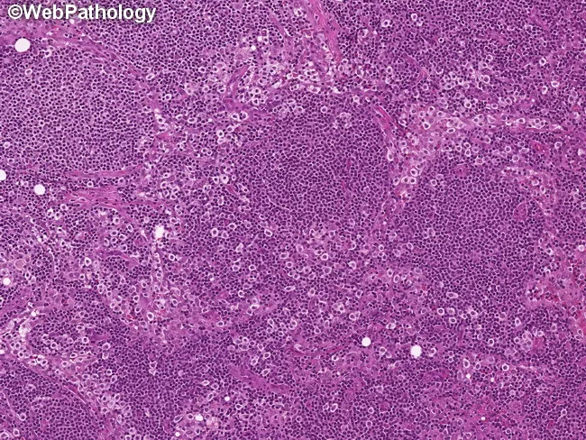 Systemic Mastocytosis : Lymph Node