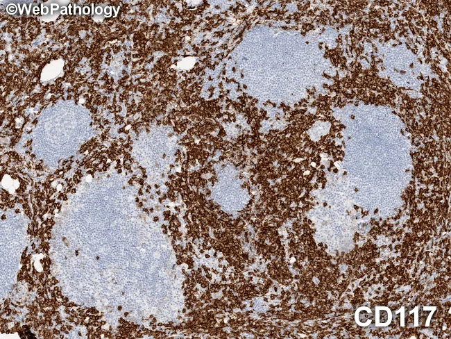 Systemic Mastocytosis : Lymph Node - CD117